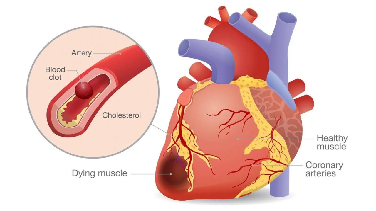 Differences Between Heart Attack Cardiac Arrest Stroke And Brain